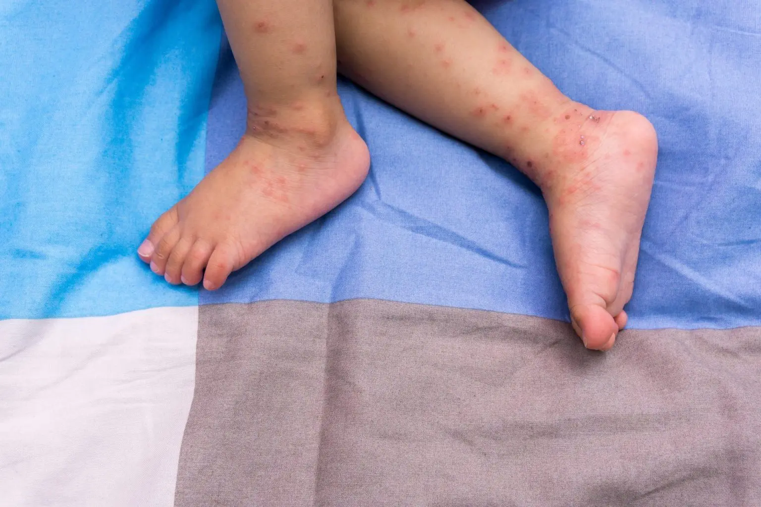 Hand Foot and Mouth Disease: What It Looks Like for Adults & Kids